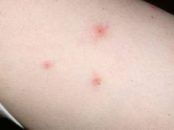 insecte de pat – DoctorulZilei