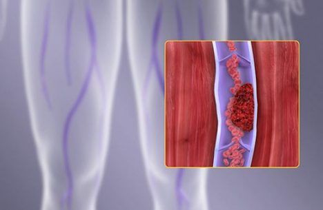 Tromboza venoasă profundă – simptome și complicații. Cum se poate ...