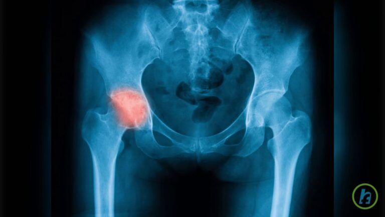 Cel mai bun tratament pentru coxartroză. Ortoped: ”Elimină durerea și ...
