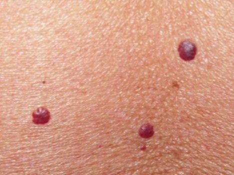 Ai multe puncte roșii pe piele? De ce apar și când trebuie să te ...