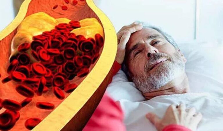 Semne de alarmă că ai colesterolul foarte mare și alimente care te ...