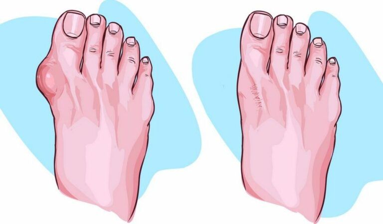 7 remedii naturale pentru ameliorarea durerii provocată de monturi ...