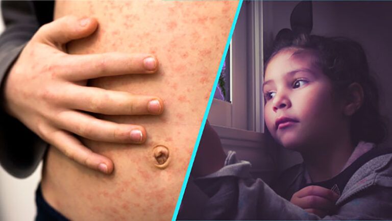 Focar de rujeolă în Europa: 5 semne și simptome comune