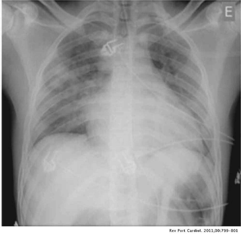 Durerea în piept când tușești, poate semnala o afecțiune la plămâni