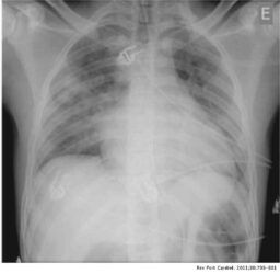 Simptome cancer plămâni. Primele semne de alarmă că boala s-a instalat