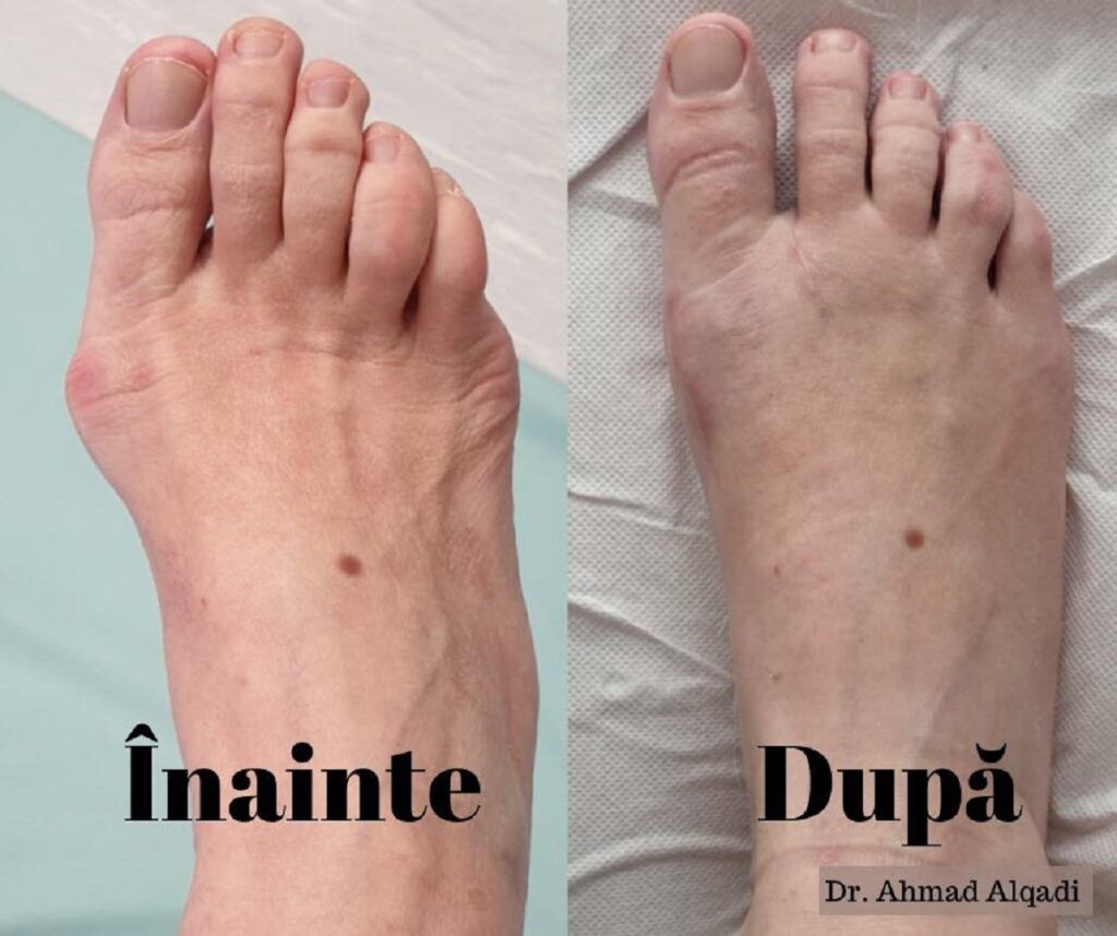 7 remedii naturale pentru ameliorarea durerii provocată de monturi ...