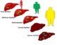 Este reversibilă steatoza hepatică? Dieta persoanelor cu ficat gras ...