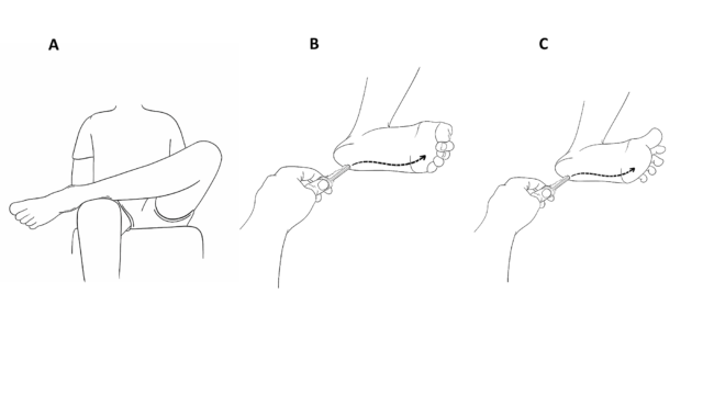 FOTO+VIDEO. Ce este semnul Babinski? Ce boli pot descifra medicii pe ...
