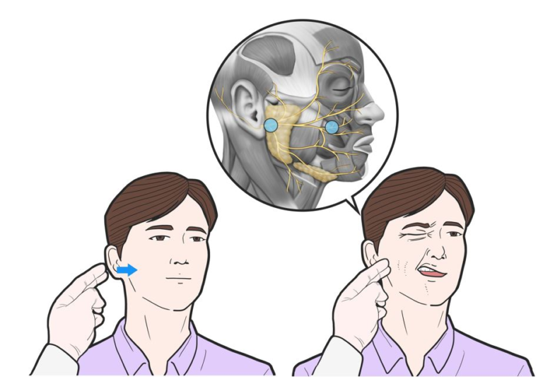 FOTO+VIDEO. Ce este semnul Chvostek? Poate semnala dereglări mari în ...