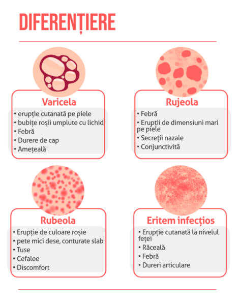 Epidemie de rujeolă: ce este rujeola și cum se manifestă? Epidemie de rujeolă: ce este rujeola și cum se manifestă?