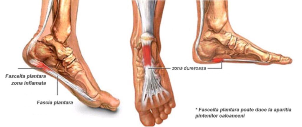 Scapă de pintenii calcaneeni ( ciocuri la călcâie) cu un amestec simplu ...