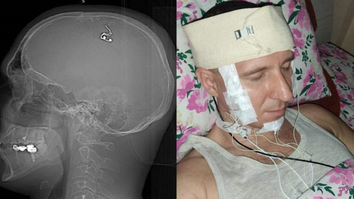 Un cercetător s-a operat singur pe creier în sufrageria sa