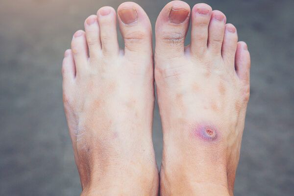 Picior diabetic: 7 simptome ascunse care apar pe picioare. Netratată la ...