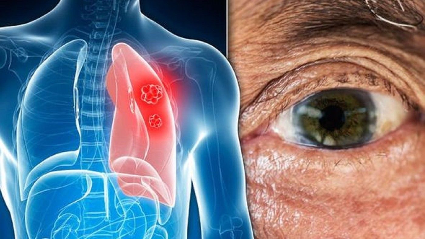 Semnul cancerului pulmonar care apare pe față