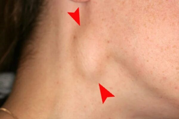 Ganglionii limfatici – DoctorulZilei