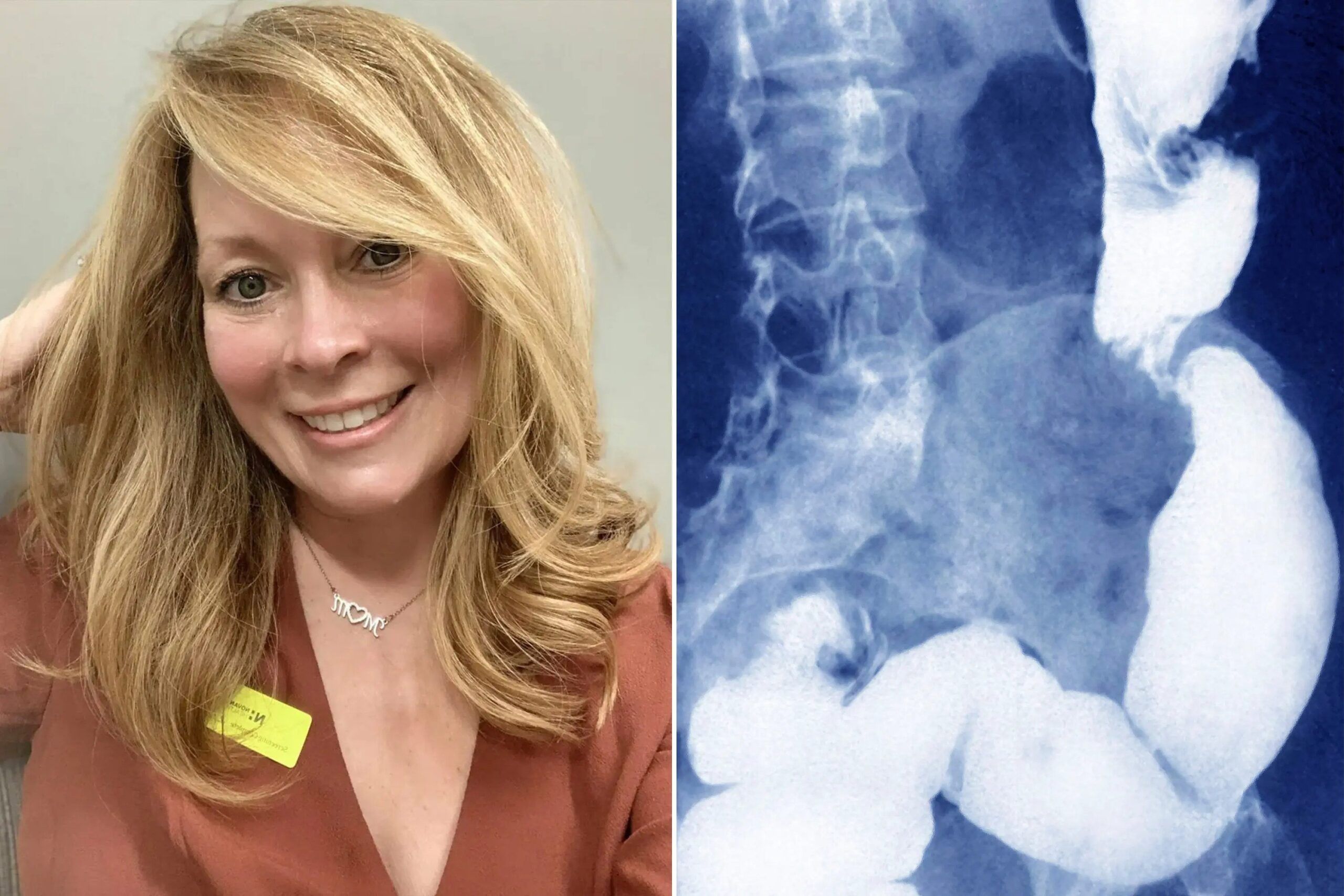 “Am avut cancer de colon de două ori. Semne pe care medicii le-au ratat”