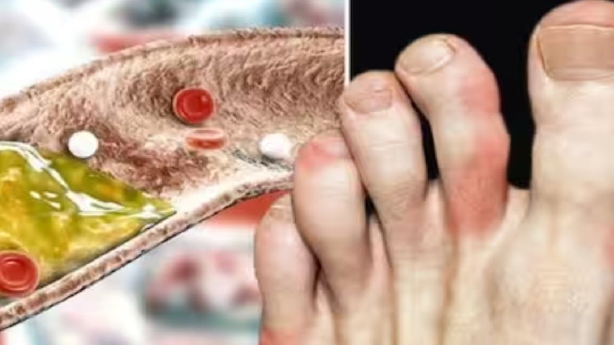 Șase semne de colesterol ridicat care apar în picioare