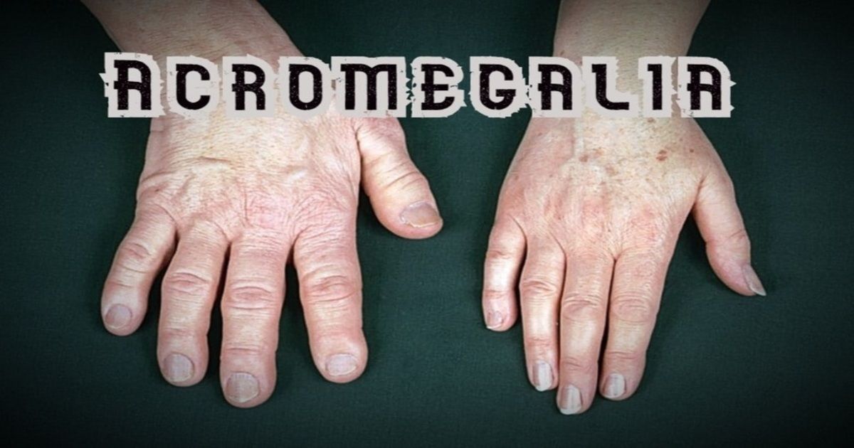 Acromegalia - o boală cronică cu potențial letal