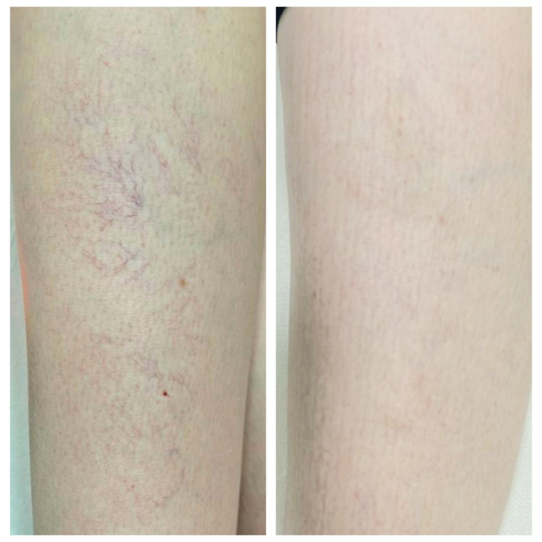 Care este cel mai eficient tratament pentru leziuni vasculare ...