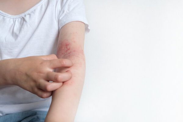 Dermatita atopică, afecțiunea de care suferă 10% din români. Șase ...