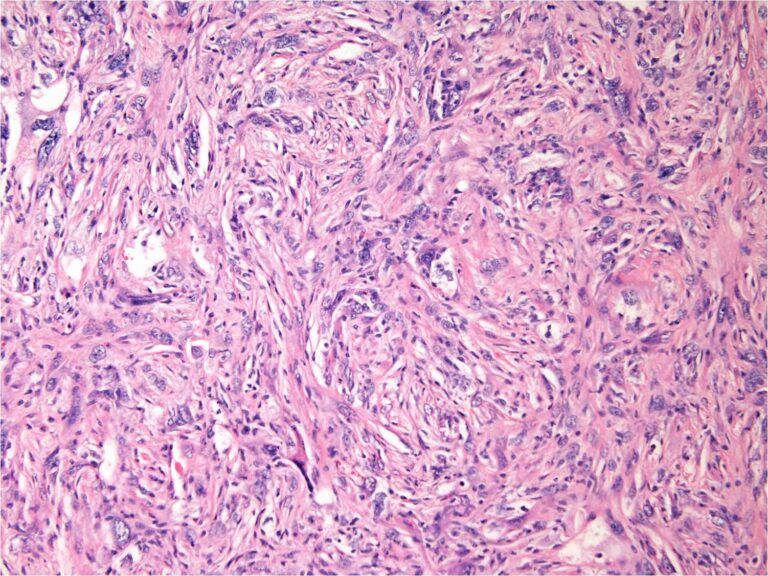 10 simptome care anunță cancerul de ficat