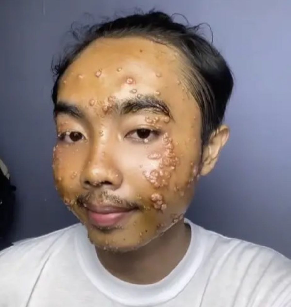 A făcut o boală de piele bizară de la haine second hand