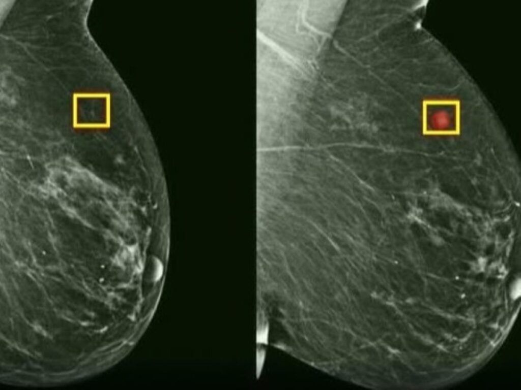 Care sunt principalii FACTORI de RISC în apariția CANCERULUI MAMAR și ...