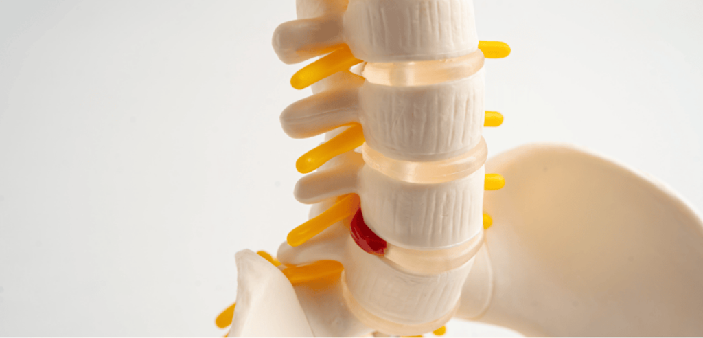 Operația de hernie de disc: totul despre riscuri și recuperare ...